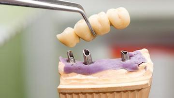 Bridges Somerset | Blog | How Does A Dental Bridge Work?